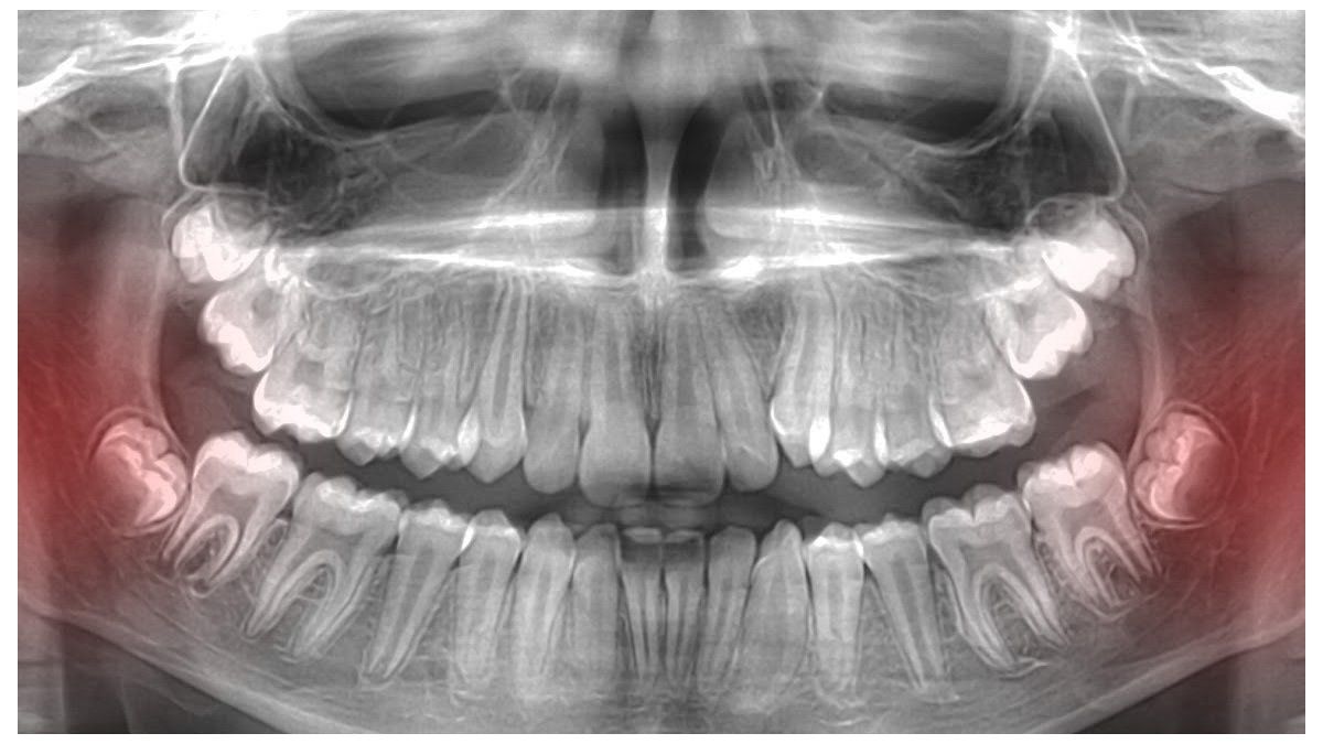 Dolor mandibular: 3 claves IMPORTANTES que debes conocer