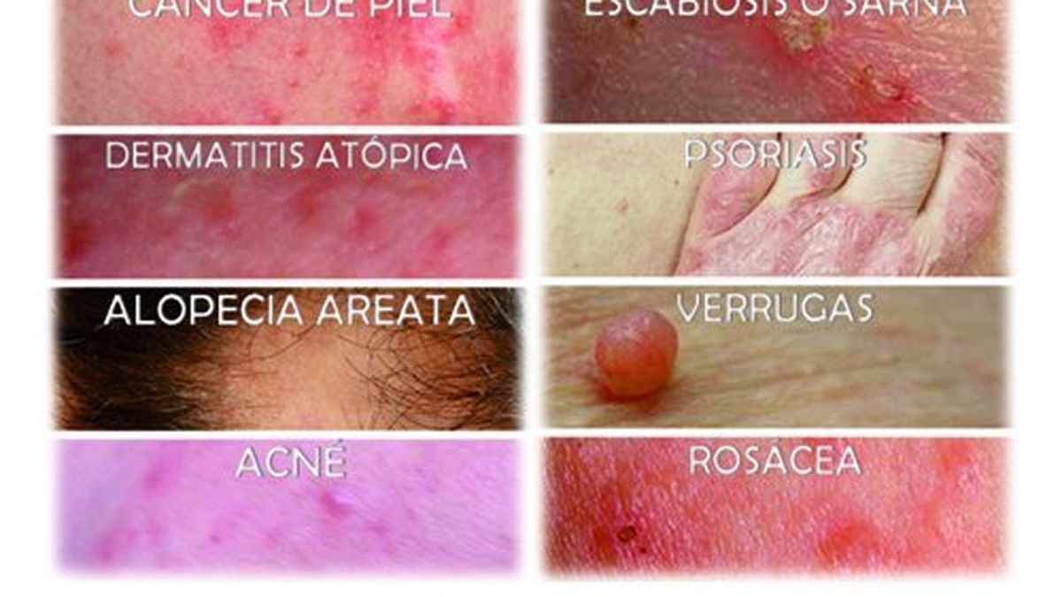 Las enfermedades más frecuentes de la PIEL
