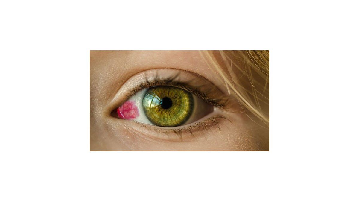 ¿Qué causa un derrame ocular y cómo tratarlo?