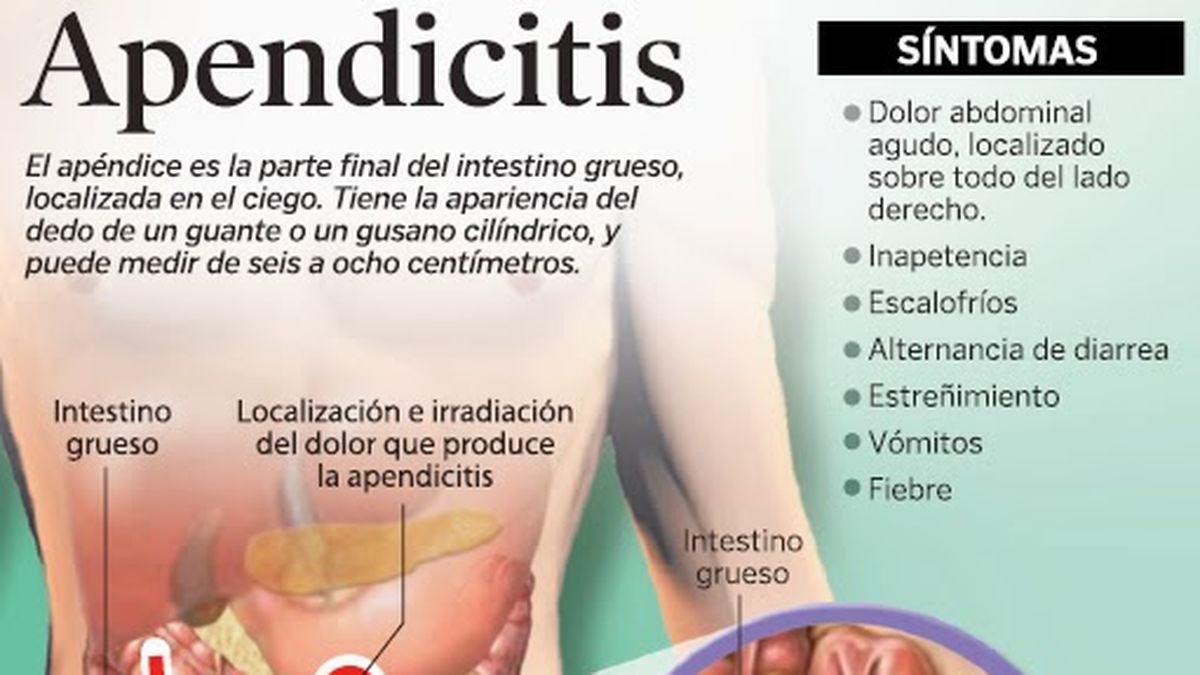 Cómo saber si tienes APENDICITIS