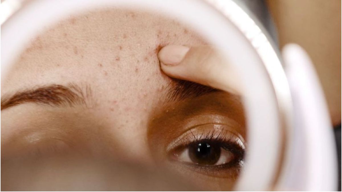 Reduce el acné de tu rostro con 2 rutinas faciales para el día y la noche