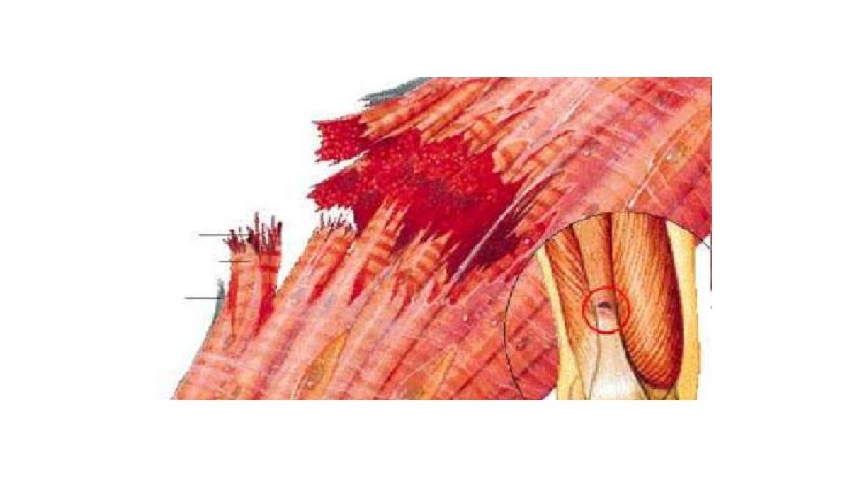 Tratar naturalmente un desgarro muscular