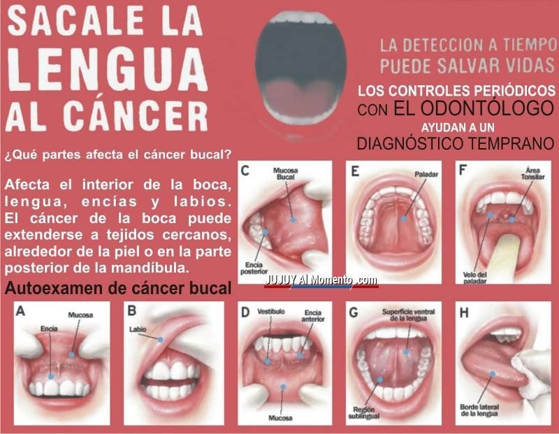 Prevenir el cáncer bucal