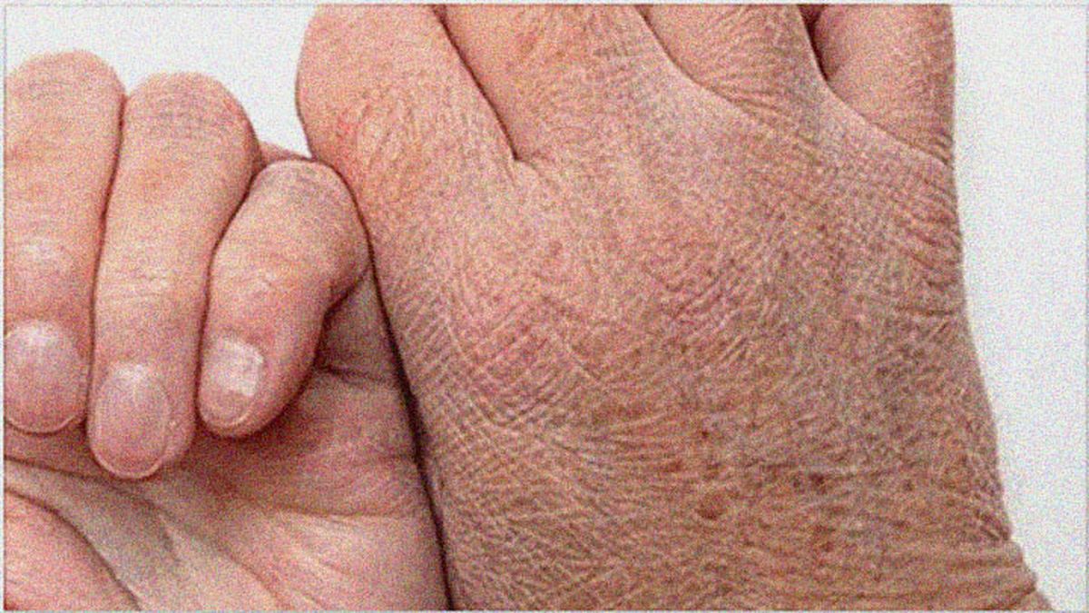 ¿Tienes la piel seca? Cuidado, podrías tener una de estas 4 enfermedades